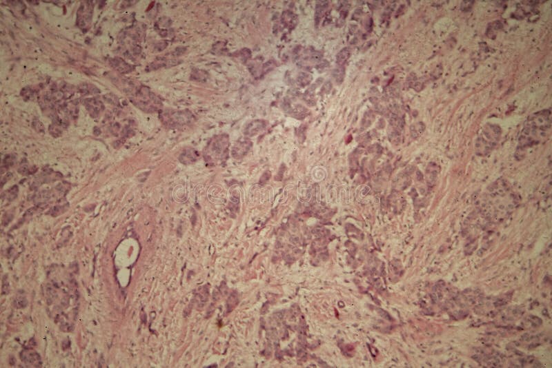 Microscopia Del Cáncer De Pecho Imagen de archivo - Imagen de malo ...