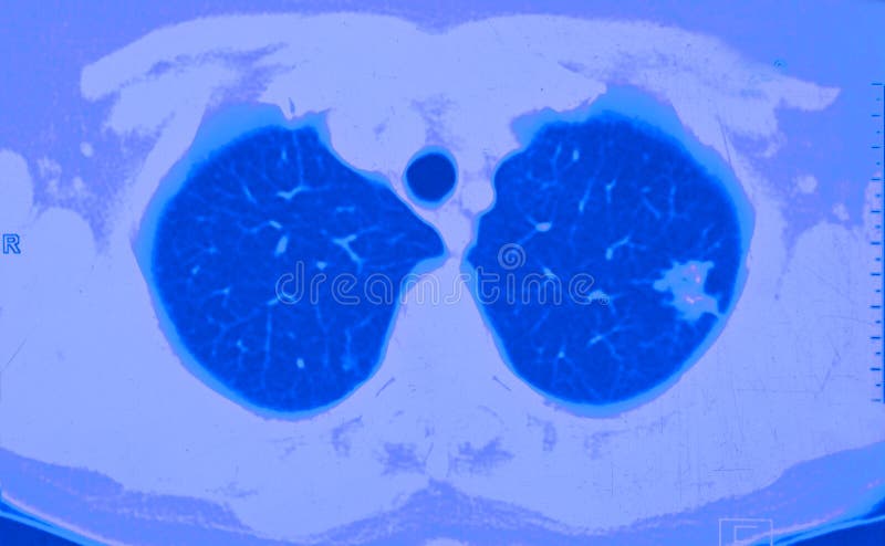 Microscopia Del Cáncer Del Intestino Imagen de archivo - Imagen de ...