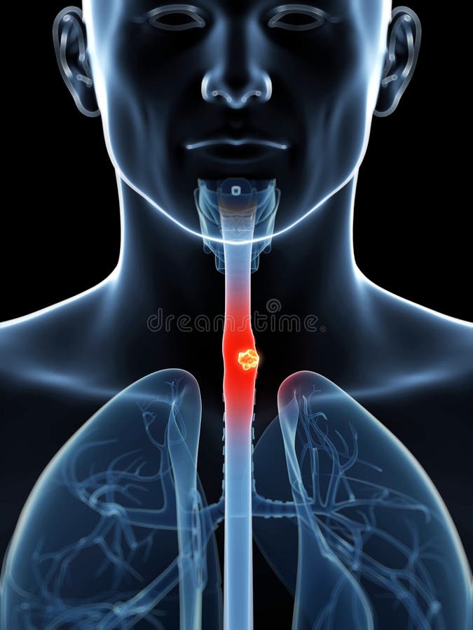 Cáncer del esófago stock de ilustración. Ilustración de garganta - 30727017