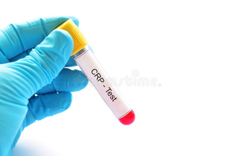 C-reactive protein test stock photo. Image of analysis - 121827592