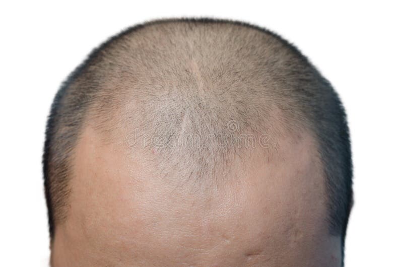 Cabeza calva foto de archivo. Imagen de mirando, pista - 42226066