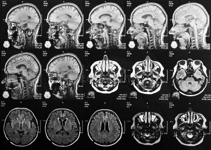 Radiografía De La Cabeza Y Del Cerebro, MRI Foto de archivo - Imagen de ...
