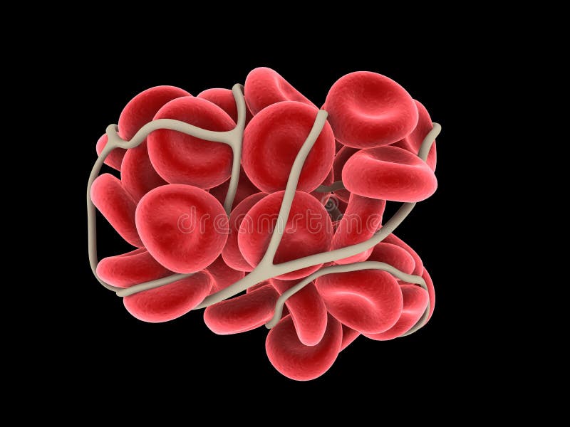 Caillot De Sang Constitué De Plaquettes De Globules Rouges Et De Brins ...