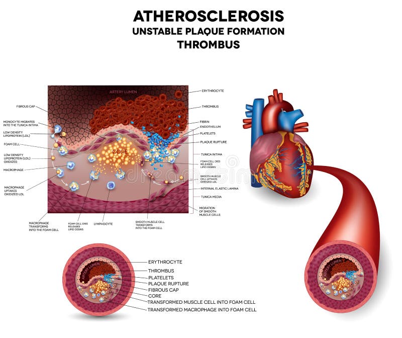 Thrombus, caillot sanguin illustration de vecteur. Illustration du ...
