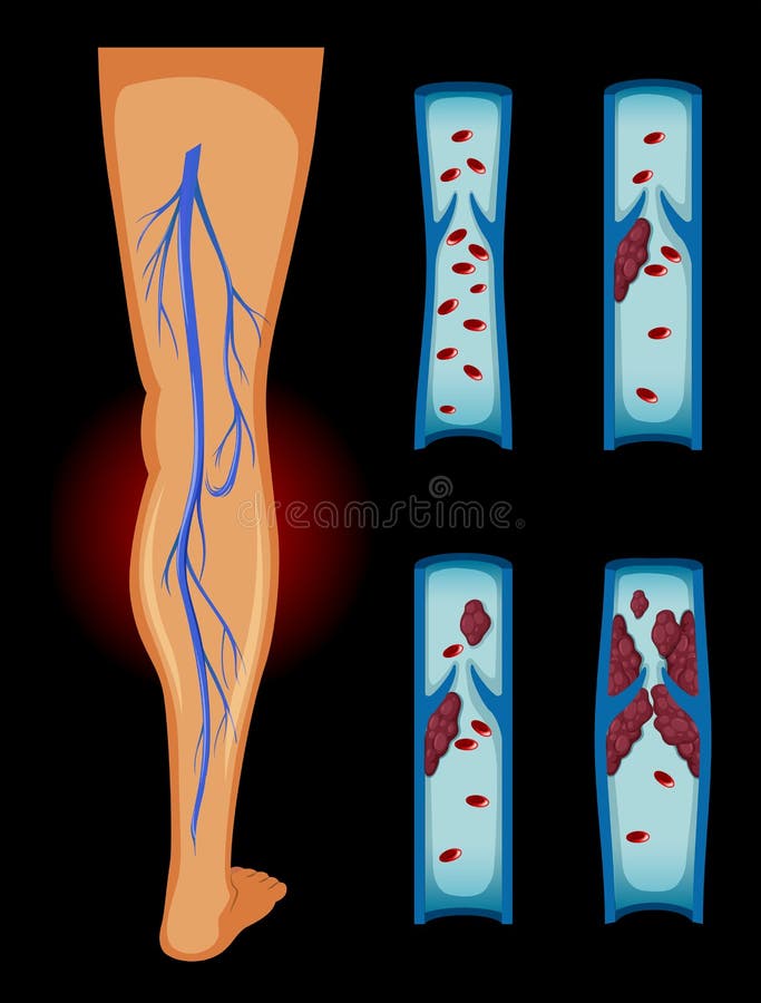 Thrombose Profonde Ou Caillots Sanguins De Veine Embolisme Illustration ...
