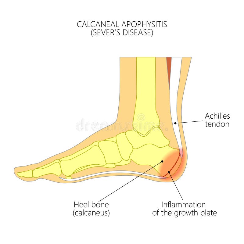 Calcaneal Apophysitis vektor abbildung. Illustration von problem - 75976069