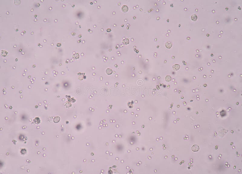 Calcium Oxalate Crystal in Urine. Stock Image - Image of acid, carbon ...