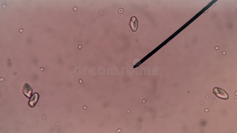 Calcium Oxalate Crystal in Urine. Stock Photo - Image of etching ...