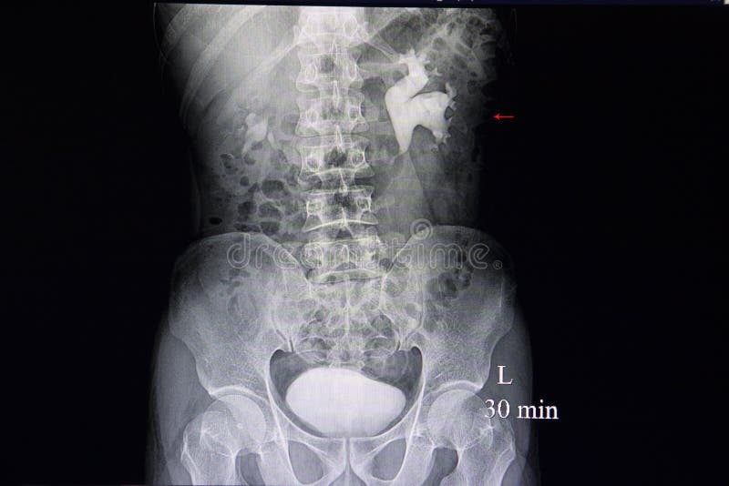Inflammation Du Rein De Hydronephrosis Dans La Section De Tissu Image ...