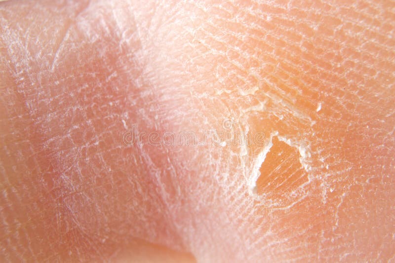 Callus stock photo. Image of medical, callus, problems - 38950850