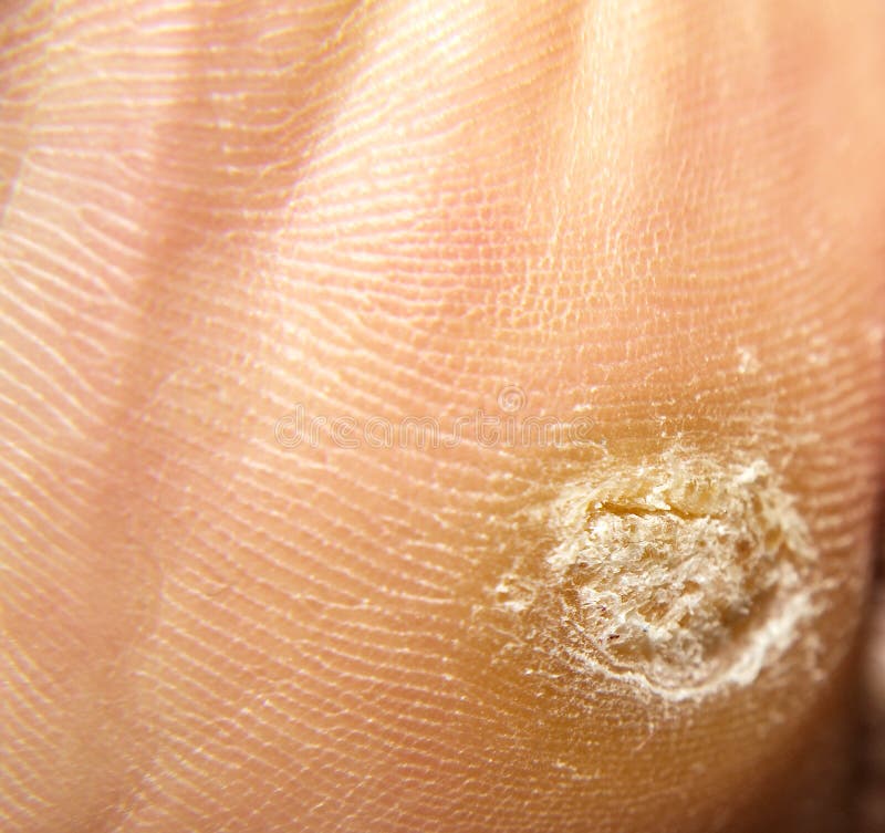 Hyperkeratosis