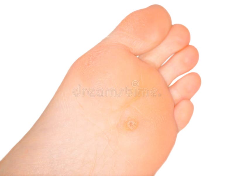 Callus under foot stock image. Image of female, white - 31570977