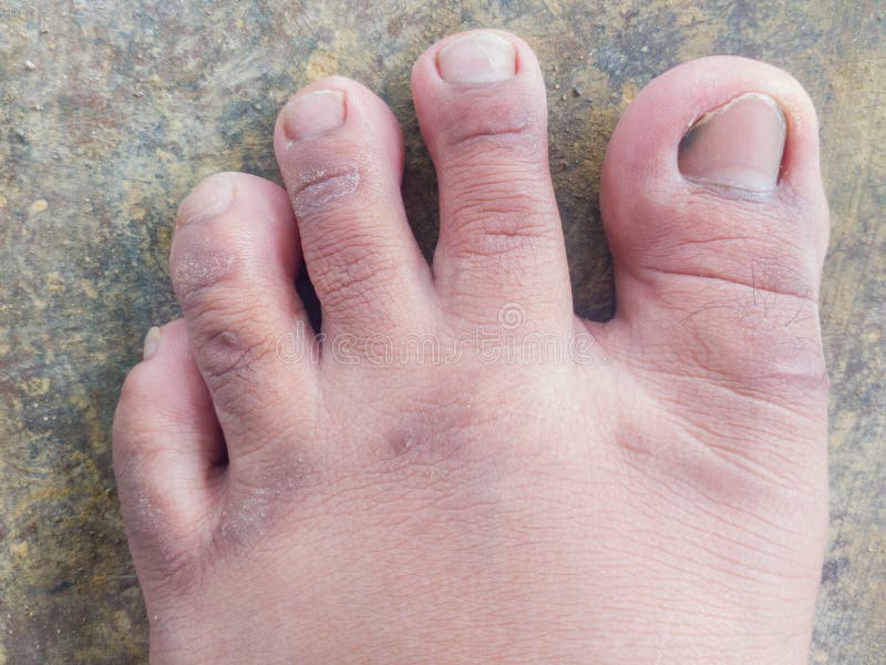 Callused Man S Toes Isolated on Cement Floor Stock Image - Image of ...