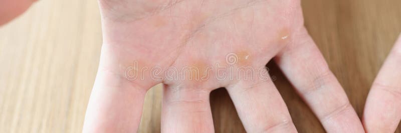 Calluses or Corns on Palmar Surface of Hand. Stock Photo - Image of ...