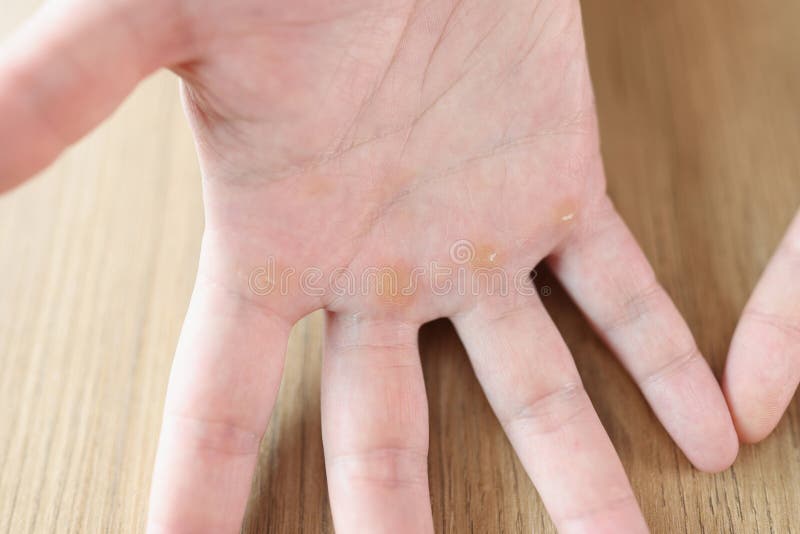Calluses or Corns on Palmar Surface of Hand. Stock Photo - Image of ...