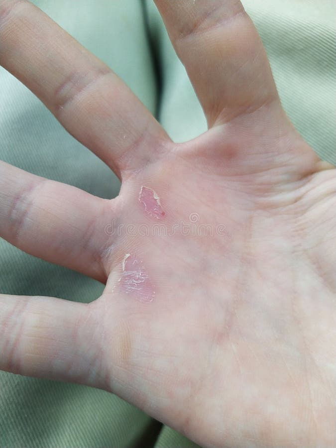 Calluses on a Man& X27;s Hand Closeup Photo Stock Image - Image of ...