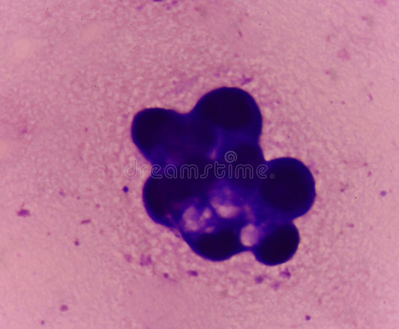 Cancer Cell in Blood Cells. Stock Photo - Image of microscope, medicine ...