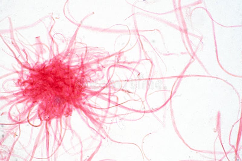 Cancer Cell in Human Under the Microscope View Stock Image - Image of ...