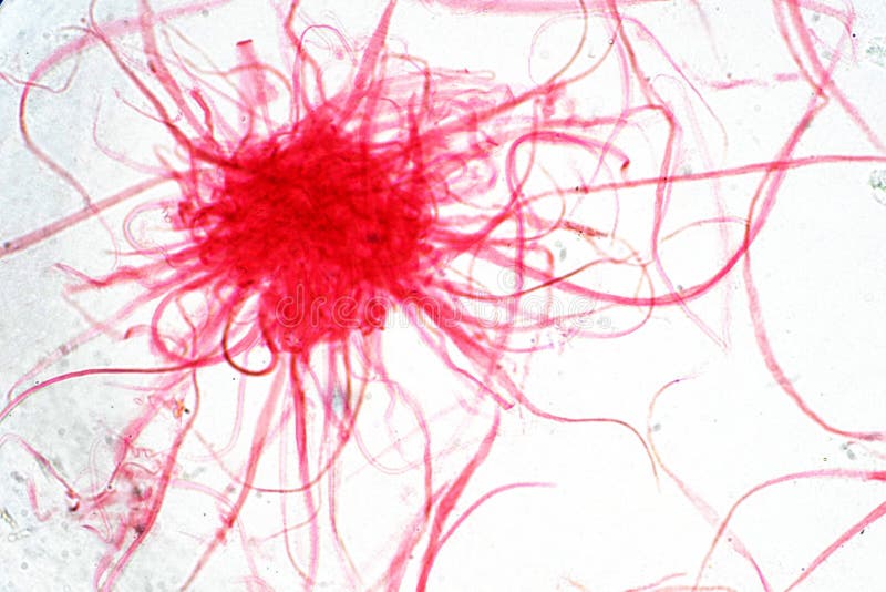 Cancer Cell in Human Under the Microscope View Stock Photo - Image of ...