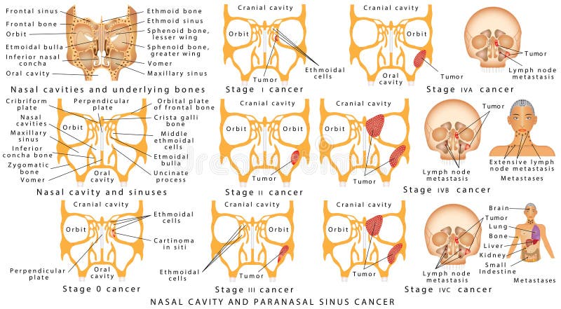 Cancer de nez illustration de vecteur. Illustration du soin - 96477937