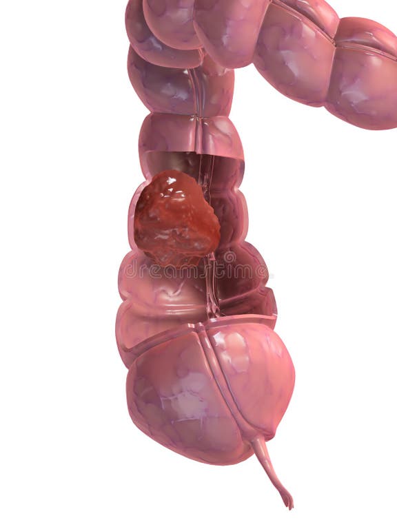 Cancer du colon illustration stock. Illustration du carcinome - 2870044