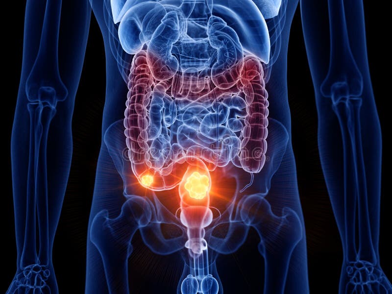 Cancer du colon illustration stock. Illustration du anatomie - 5605180