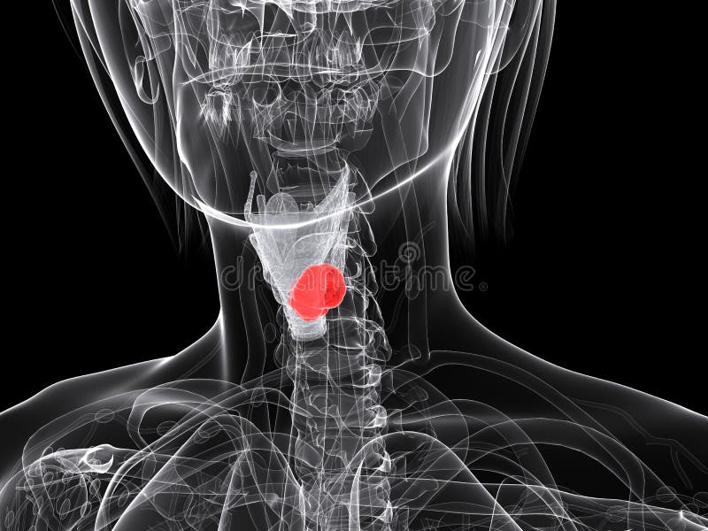 Cancro da laringe ilustração stock. Ilustração de glândula - 14391455