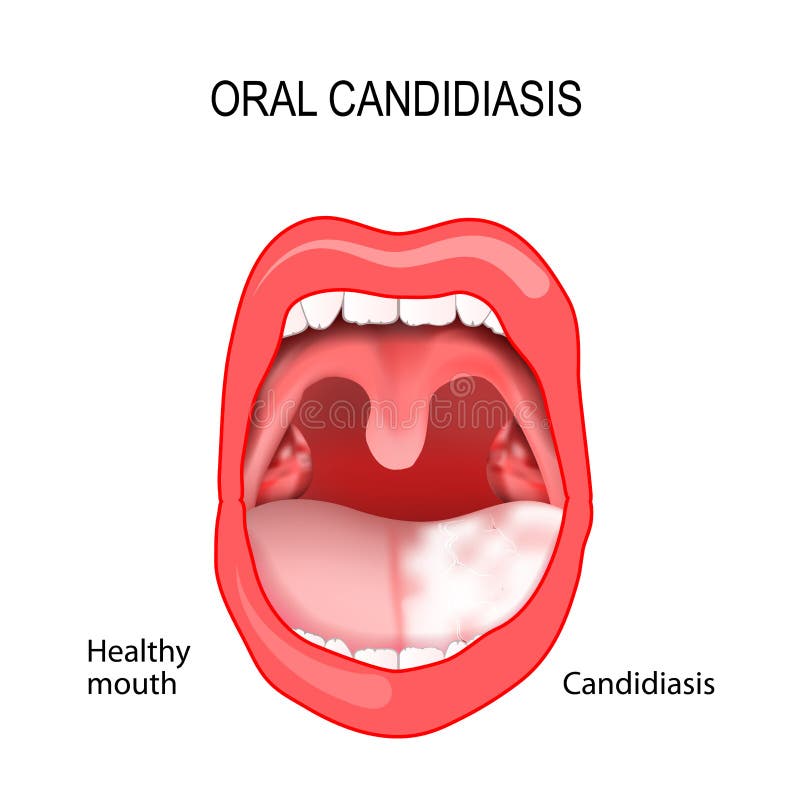 Candidiasis oral E ilustración del vector. Ilustración de hongos ...