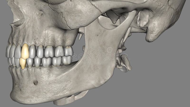 Maxillary and Mandibular Prosthesis with Gum All on 4 System Supported ...