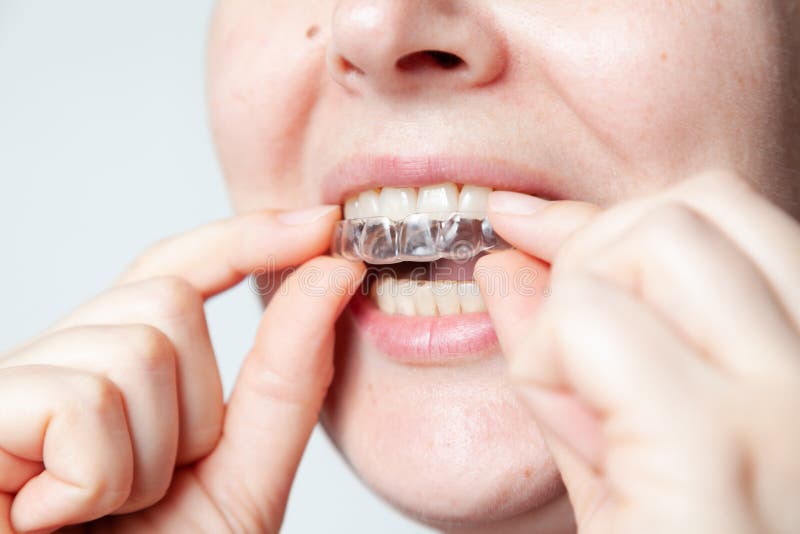 Caps for Teeth after Braces Hold Bite in Desired Position Stock Photo ... Caps for Teeth after Braces Hold Bite in Desired Position Stock Photo ...