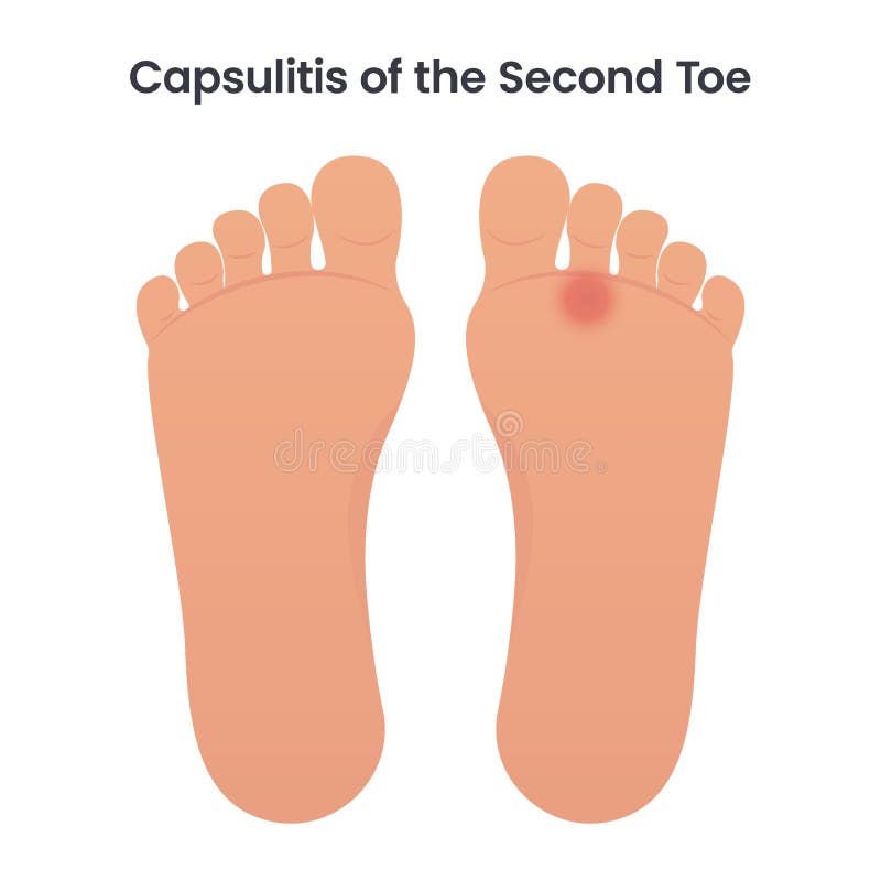 Foot Capsulitis Stock Illustrations – 22 Foot Capsulitis Stock ...