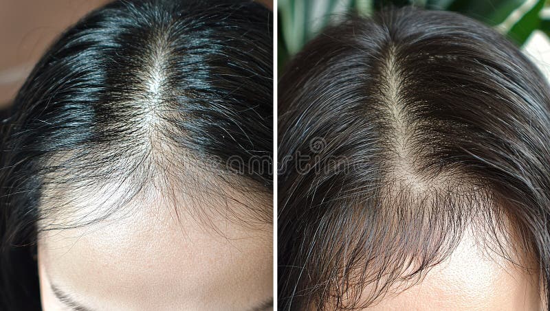 Transformative Hair Restoration before and after Showcasing Noticeable ...