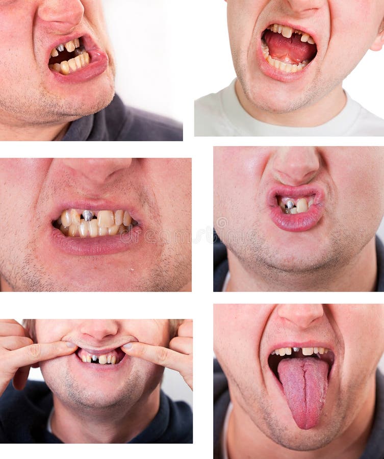 Malos dientes foto de archivo. Imagen de amarillento - 39569466