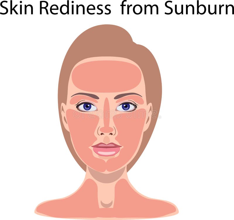 Cara Del Vector Con La Piel Quemada Ilustración del Vector ...