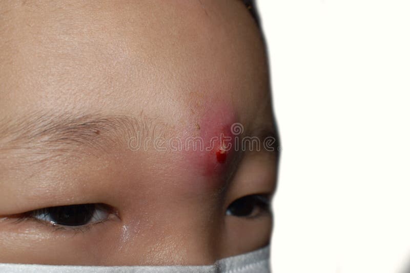 Carbuncle or Abscess at Forehead Stock Photo - Image of face, bacterial ...