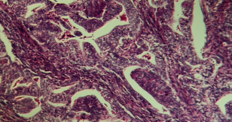 Carcinoma of the Stomach in Cross Section Stock Footage - Video of ...