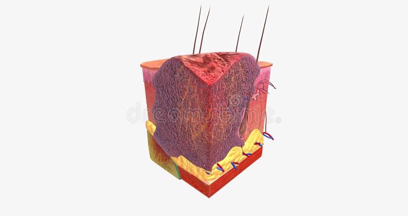 Carcinome Basocellulaire Dans Le Stade Tissulaire Iii Illustration ...