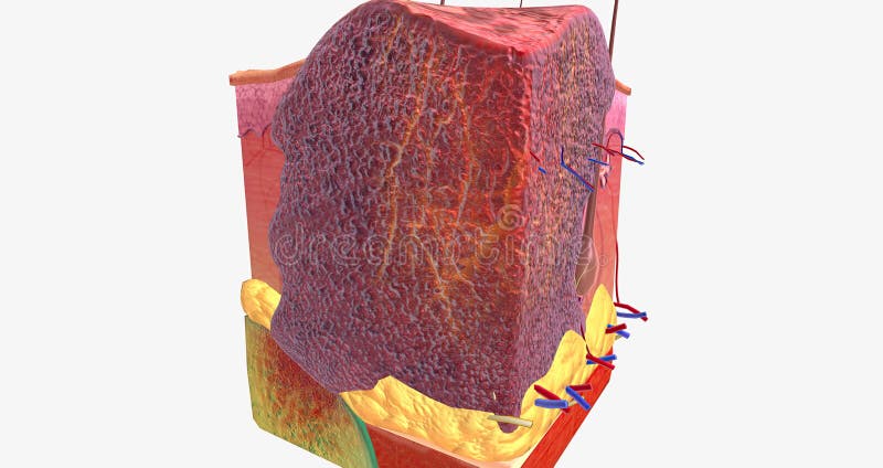 Carcinome Basocellulaire Dans Le Stade Tissulaire Iii Illustration ...