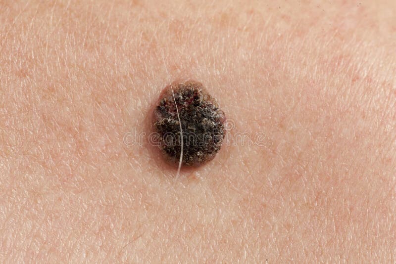 Carcinoom Van De Keratinizings Het Squamous Cel Van De Huid Stock ...