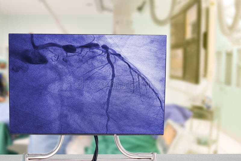 Coronary Angiogram CAG on LCD Monitor and Blurred of Modern Cath Lab ...