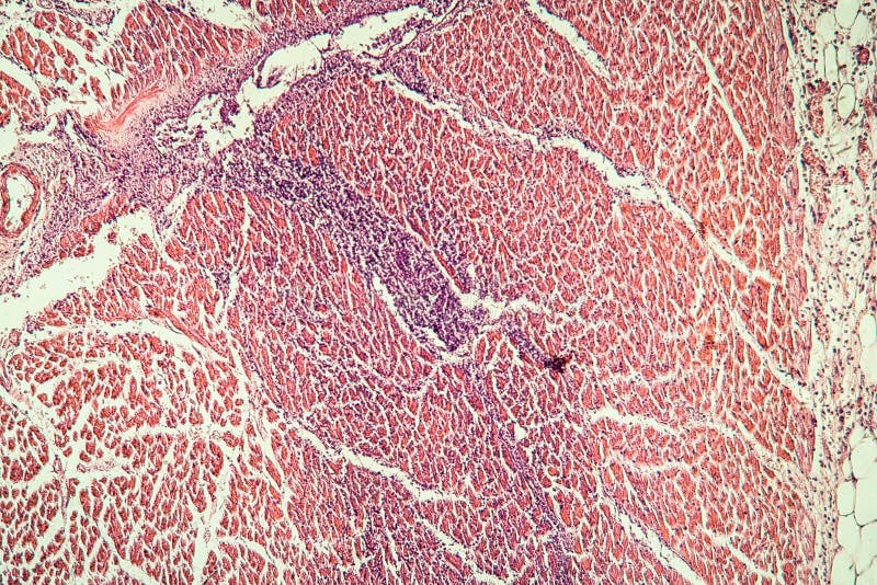 Cardiac Muscle after Infarction, Tissue Section Stock Image - Image of ...