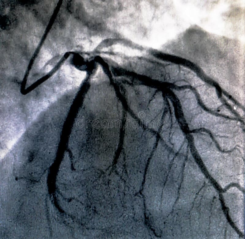 Cardiac Ventriculography. Catheterization Stock Photo - Image of ...