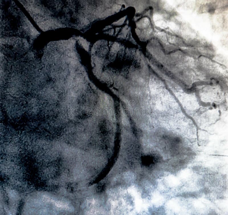 Cardiac Ventriculography. Catheterization Stock Photo - Image of aorta ...