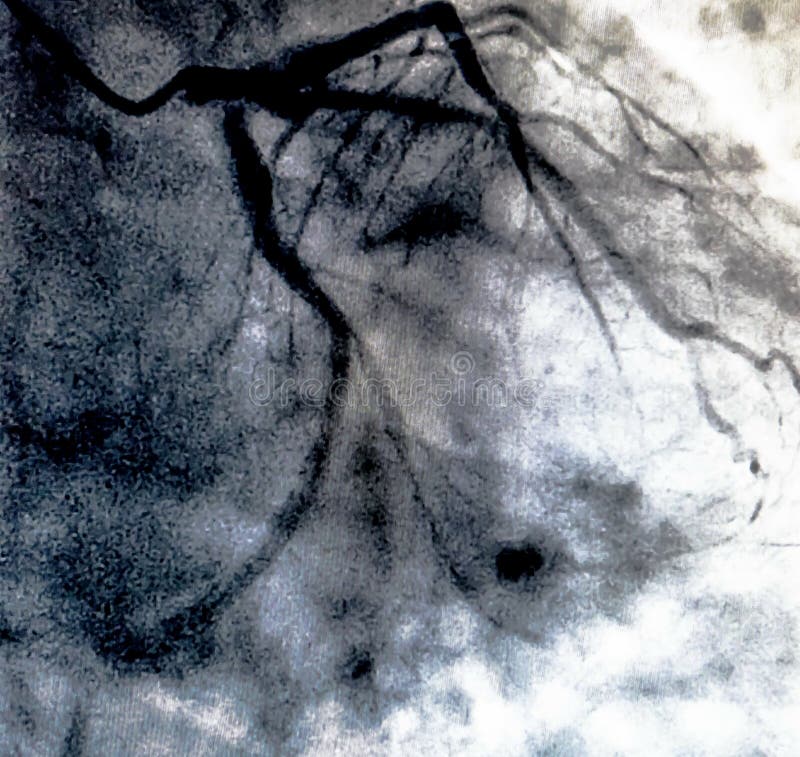 Cardiac Ventriculography. Catheterization Stock Image - Image of ...