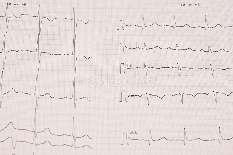 Cardiogram stock foto. Image of druk, diagnose, pulseren - 34688014