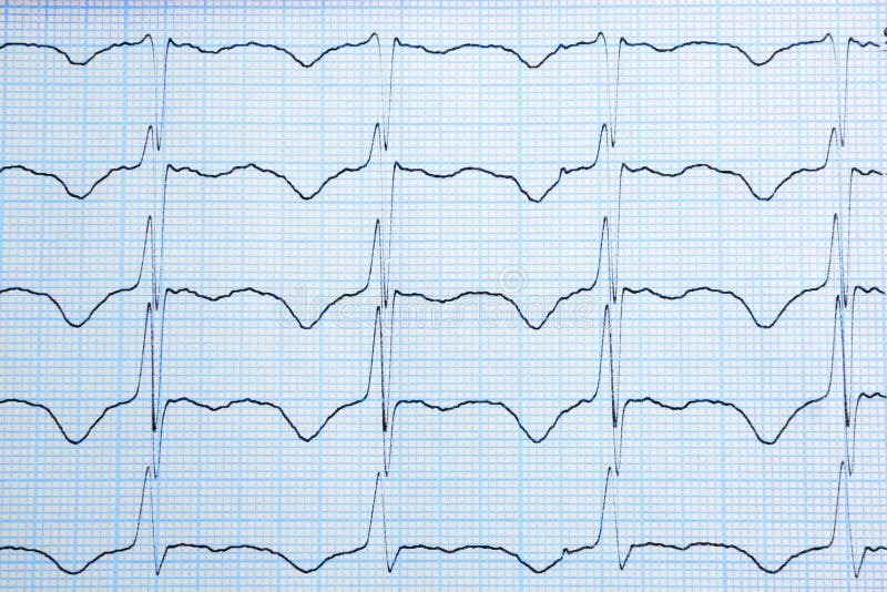 Cardiogram on a Graph Paper. Heartbeat Line. Vector Illustration Stock ...
