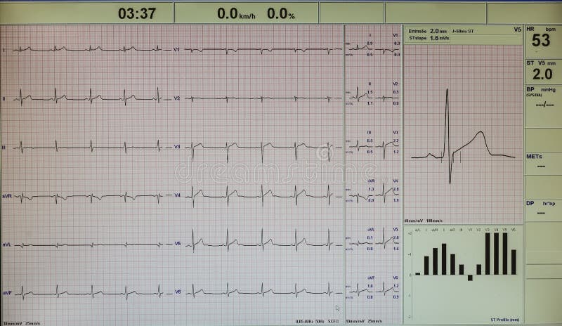 Cardiogram Image on Computer Screen at the Hospital Stock Image - Image ...