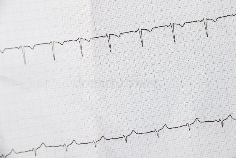 Cardiogram, Waves of Heart Beat, EKG on the Paper Stock Image - Image ...