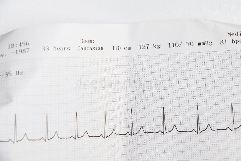 Cardiogram, Waves of Heart Beat, EKG on the Paper Stock Image - Image ...