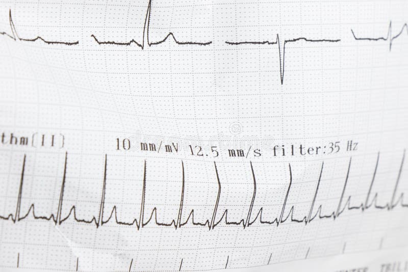 Cardiogram, Waves of Heart Beat, EKG on the Paper Stock Photo - Image ...